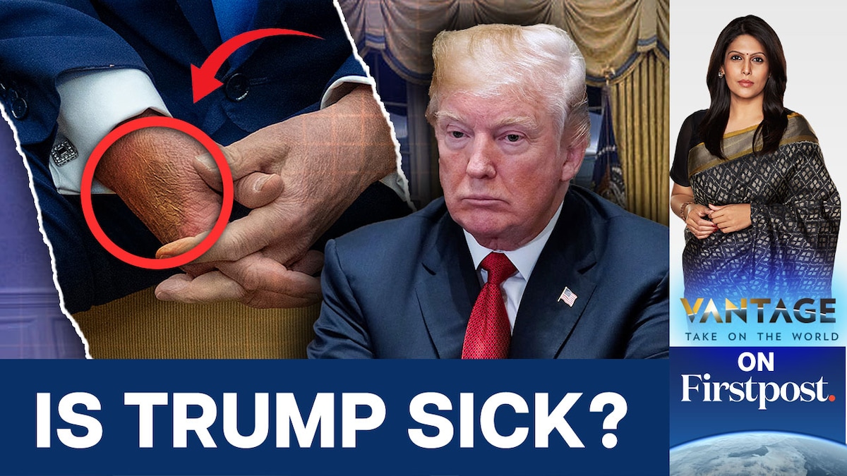 Mysterious Bruise Appears on Trump's Hand. Where Did it Come From ...